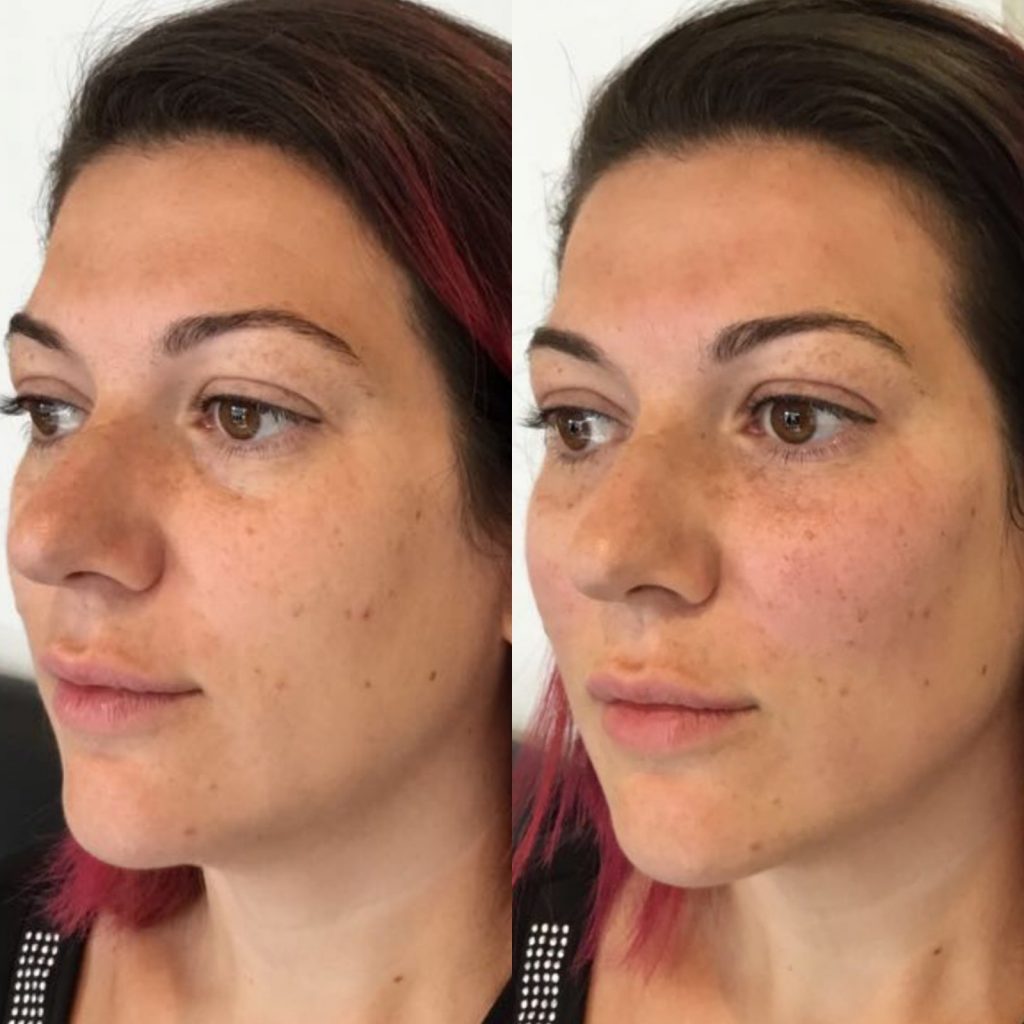 Cheek & Cheek Bone Filler in London- Free Video Consult