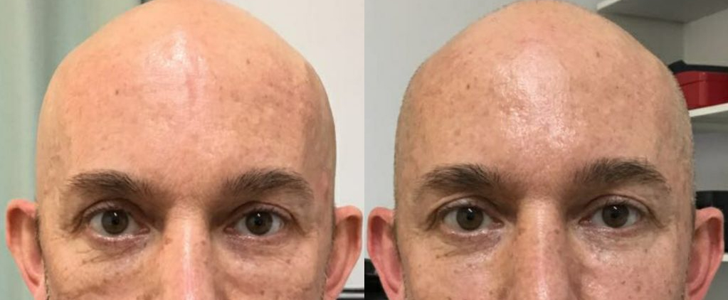 Dermal Filler for Hollow Temples-London-Free Video Consultation